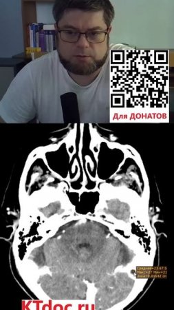 Расшифровка КТ и МРТ головы #mentor #ct #кт #наставник #мрт #mri #mentor #наставник  #ktdoc #ктдок