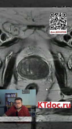 Предстательная железа на МРТ #mentor #ct #кт #наставник #мрт #mri #mentor #наставник  #ktdoc #ктдок