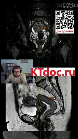 Опухоль кишки на МРТ #mentor #ct #кт #наставник #мрт #mri #mentor #наставник  #ktdoc #ктдок