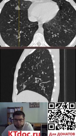 Расшифровка КТ и МРТ лёгких #mentor #ct #кт #наставник #мрт #mri #mentor #наставник  #ktdoc #ктдок