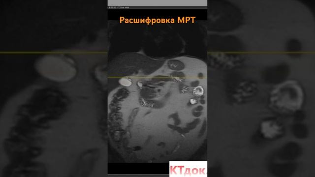 Расшифровка МРТ