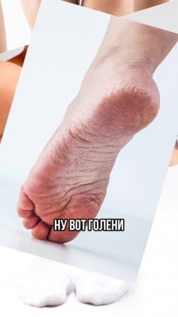 Сухие голени - проверьте щитовидку.