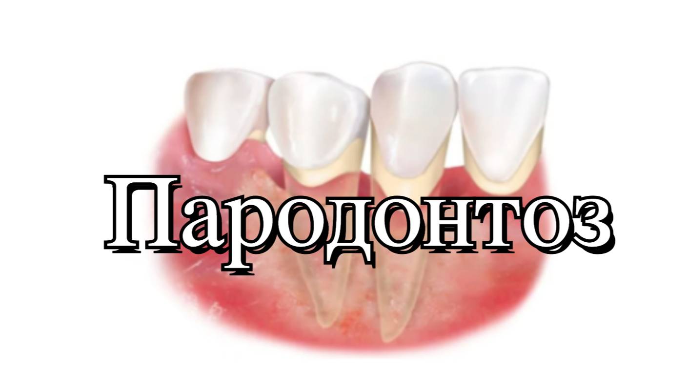 💥 Пародонтоз