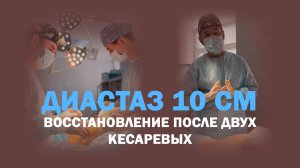 Фигура после двух родов: маммопластика + абдоминопластика в одной операции
