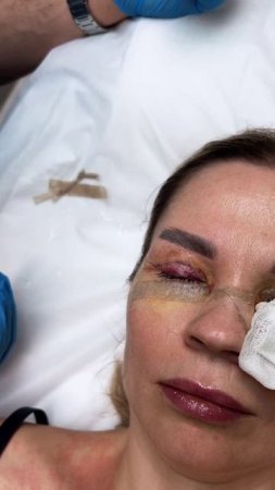 Осмотр через неделю после пластики век - снятие швов и отзыв пациентки
