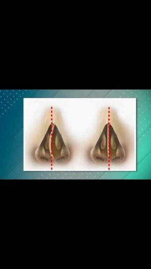 Если ноздри разного размера, можно ли это исправить?  #ринопластика