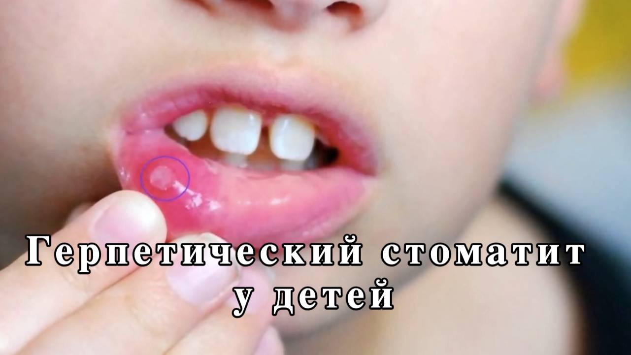 💥 Герпетический стоматит у детей — как распознать и что делать?