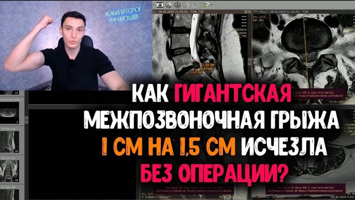 Грыжа гигант 1см на 1.5 см ушла без всего! КАК?