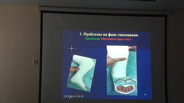 Осложнения при лечении косолапости по методу Понсети. Вавилов Максим Александрович.