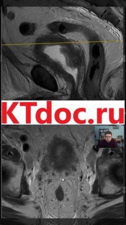 Мочевой_пузырь