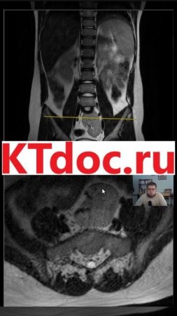 Тазовая_почка