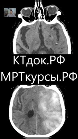 Ишемия и геморраж