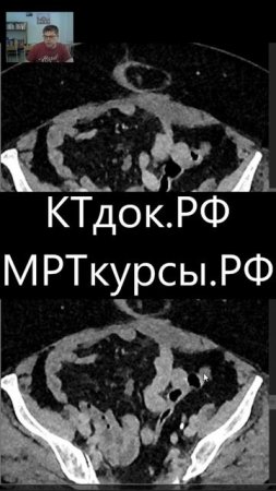 Канцероматоз