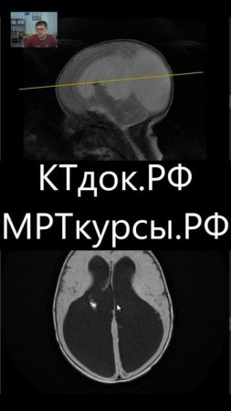 Агенезия мозолистого тела