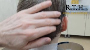 1,5 года спустя: смотрим на донорскую зону после пересадки волос!
