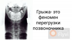 Грыжа-это феномен перегрузки позвоночника