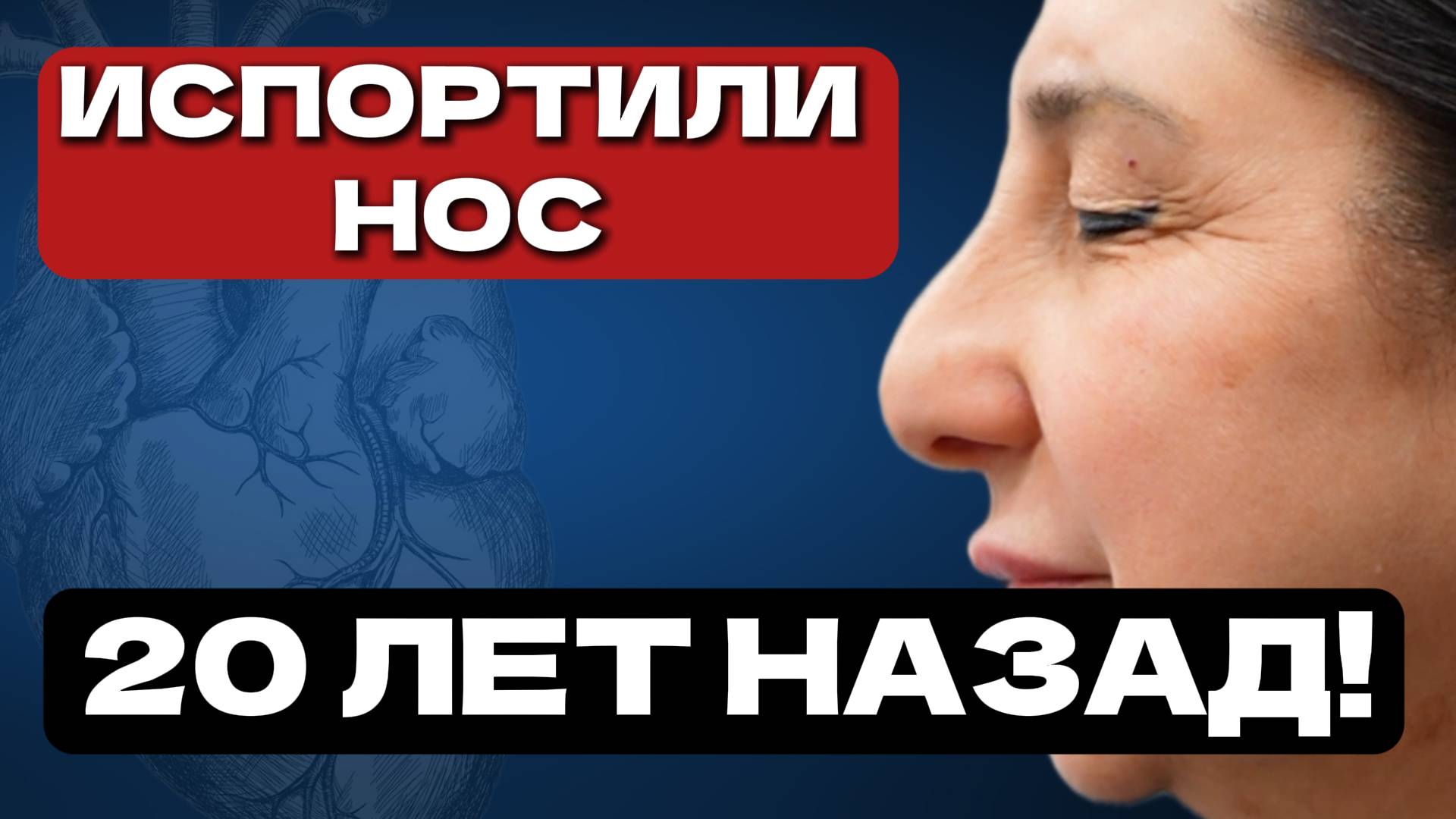 Ринопластика через 20 лет: пациентка в шоке от результата