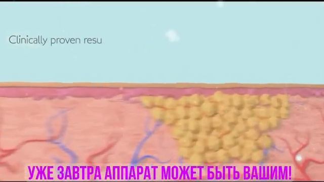Криолиполиз COCCON https://dzen.ru/coccon
