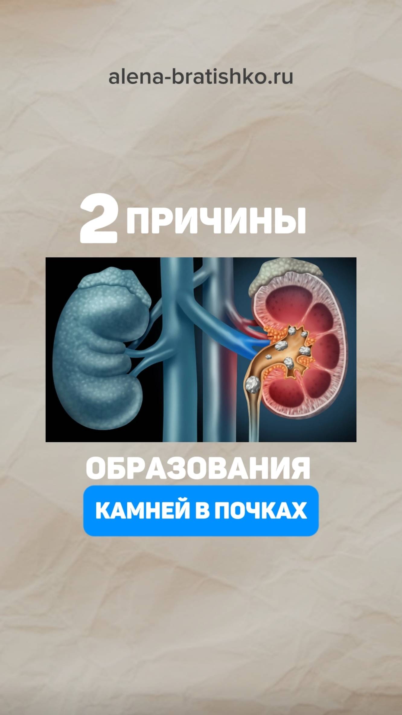 2 причины, из-за которых образуются камни в почках. Семейный доктор Алена Братишко
