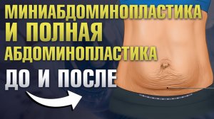 Абдоминопластика и миниабдоминопластика: в чем разница и что выбрать?/ Хирург Сергей Свиридов