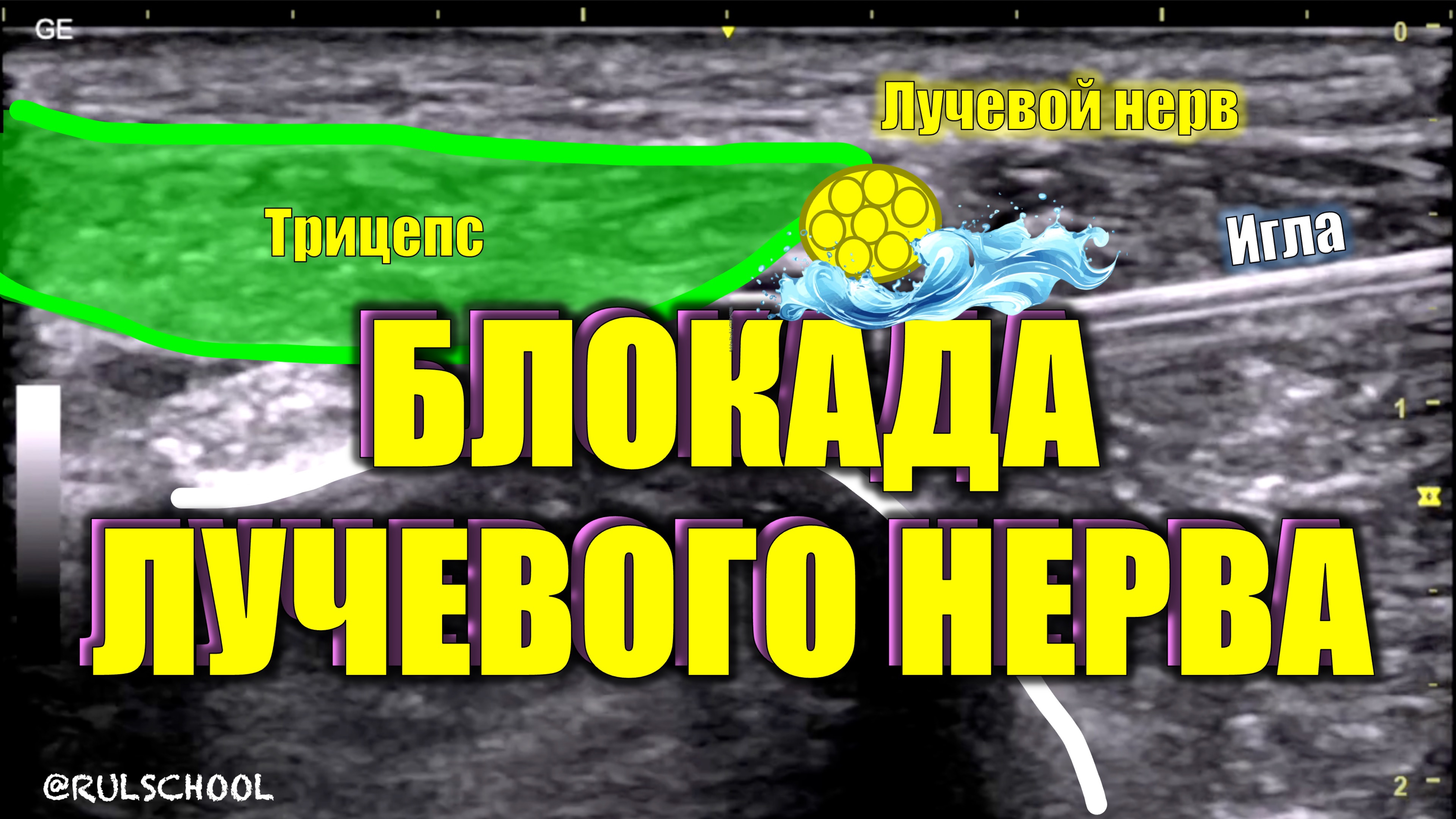 БЛОКАДА ЛУЧЕВОГО НЕРВА в нижней трети плеча. Медиальный доступ
#painmanagment #узинавигация