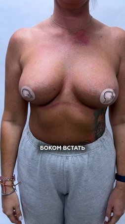 Что будет с вашей грудью через 7 ЛЕТ ПОСЛЕ маммопластики? #маммопластика #пластика #грудь