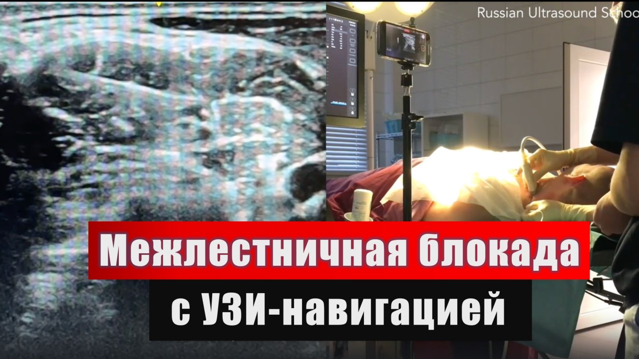 МЕЖЛЕСТНИЧНАЯ БЛОКАДА ПЛЕЧЕВОГО СПЛЕТЕНИЯ
#regionalanesthesia #узинавигация #регионарнаяанестезия