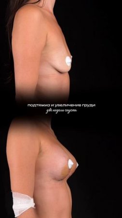 Подтяжка груди с увеличением - результат через 2 недели после пластики груди