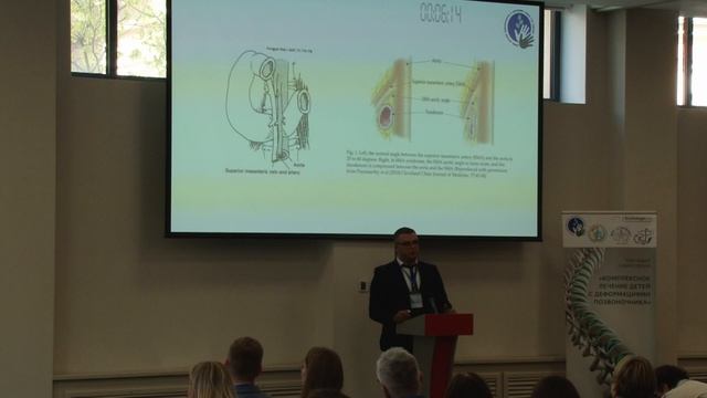Результаты хирургического лечения пациентов с идиопатическим сколиозом