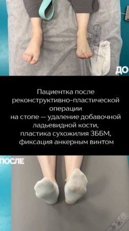 На видео результат через неделю после занятий со специалистом по физической реабилитации