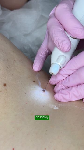 Удаление новообразований