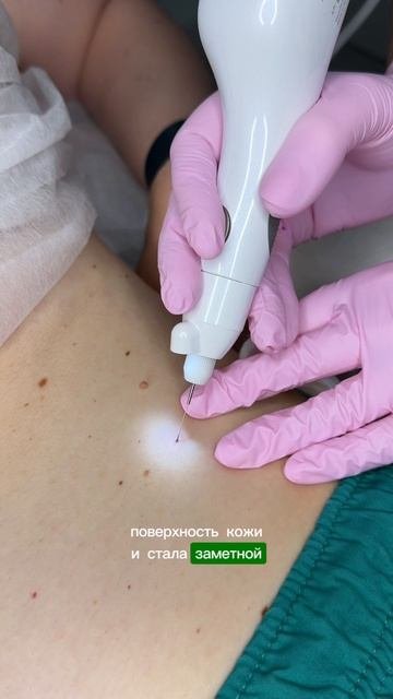 Гемангиома: подробности и удаление