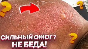 Что делать если вы сгорели на солнце?! #лайфхаки #советы