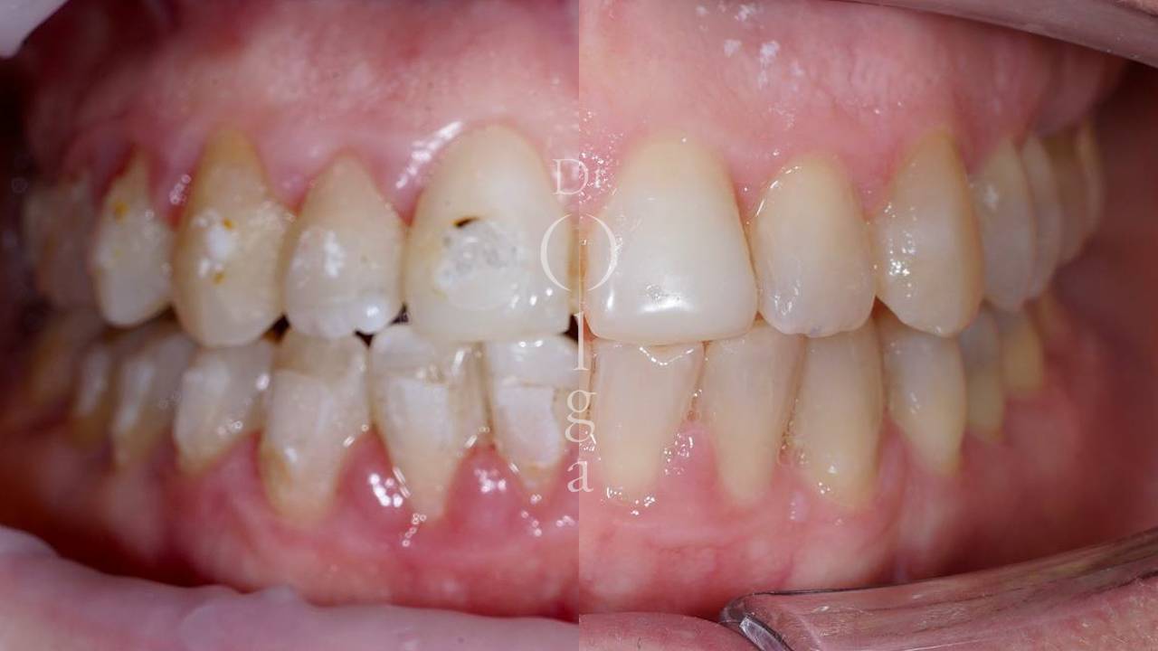 Кровоточивость дёсен после брекетов: результат лечения