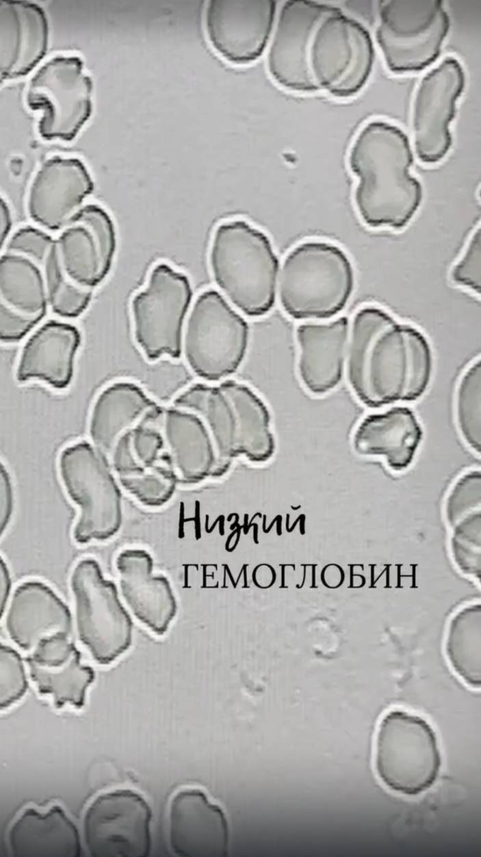 Кровь человека с очень низким гемоглобином