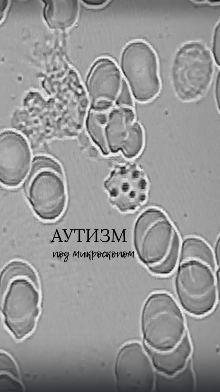 Аутизм у детей. Клетки крови под микроскопом