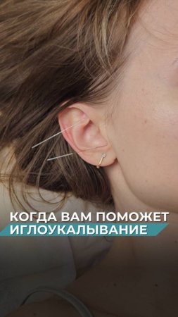 Рефлексотерапия. Иглоукалывание. Лечение иглами