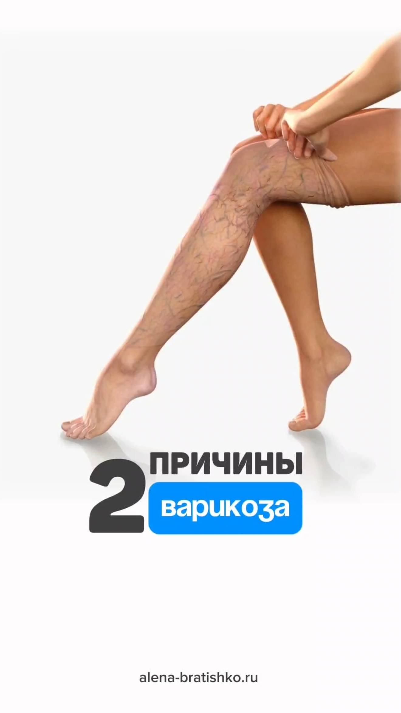 2 причины варикоза