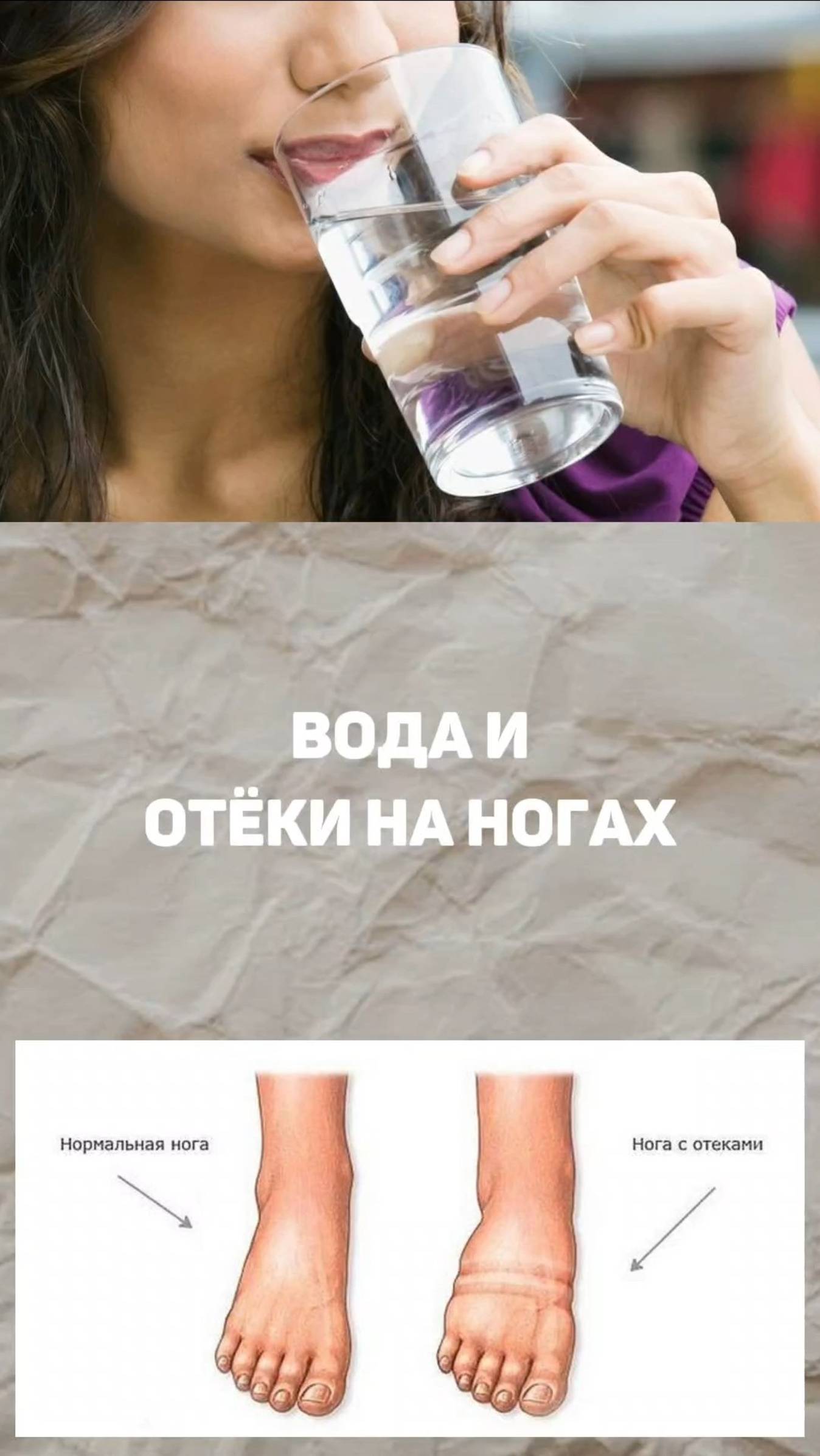 Вода и отеки на ногах