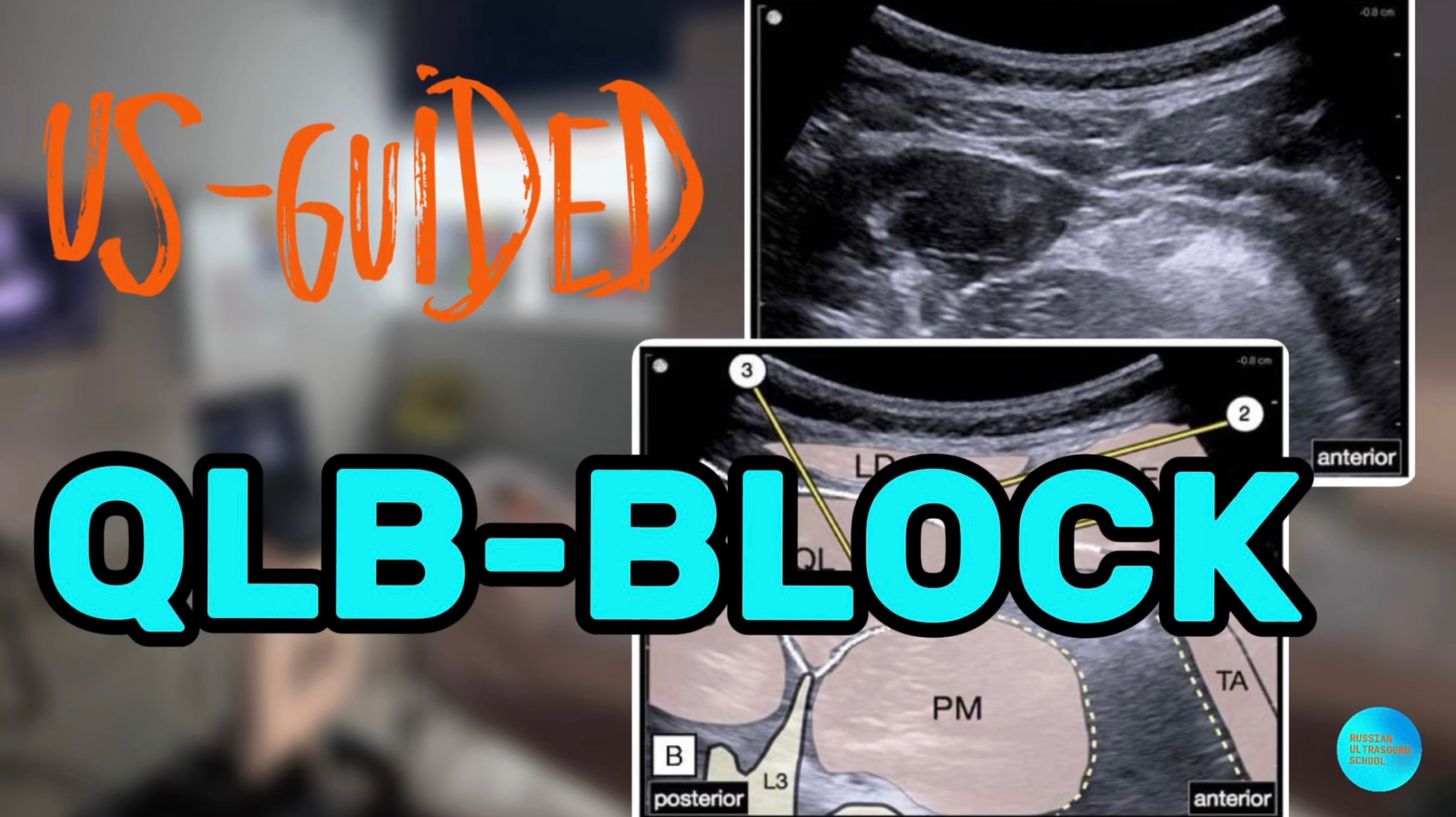 QLB-блокада  #УЗИ #навигация #anesthesiology #QLB