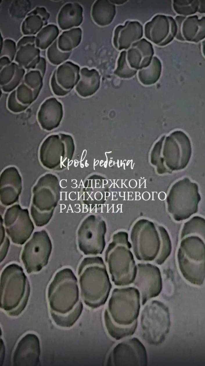 Кровь ребёнка с задержкой психоречевого развития