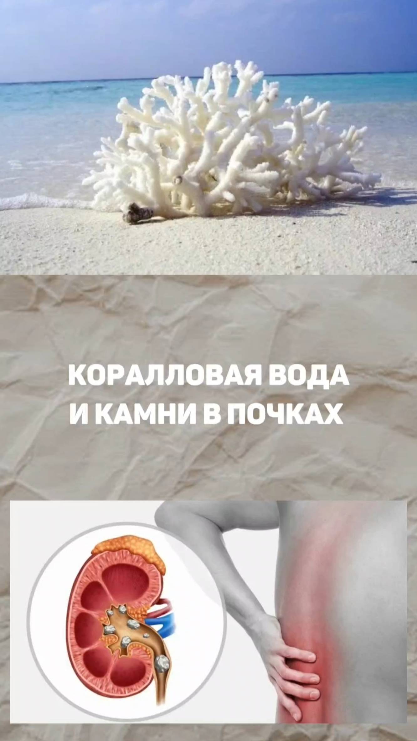 Коралловая вода и камни в почках