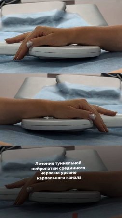 Лечение туннельной нейропатии срединного нерва на уровне карпального канала