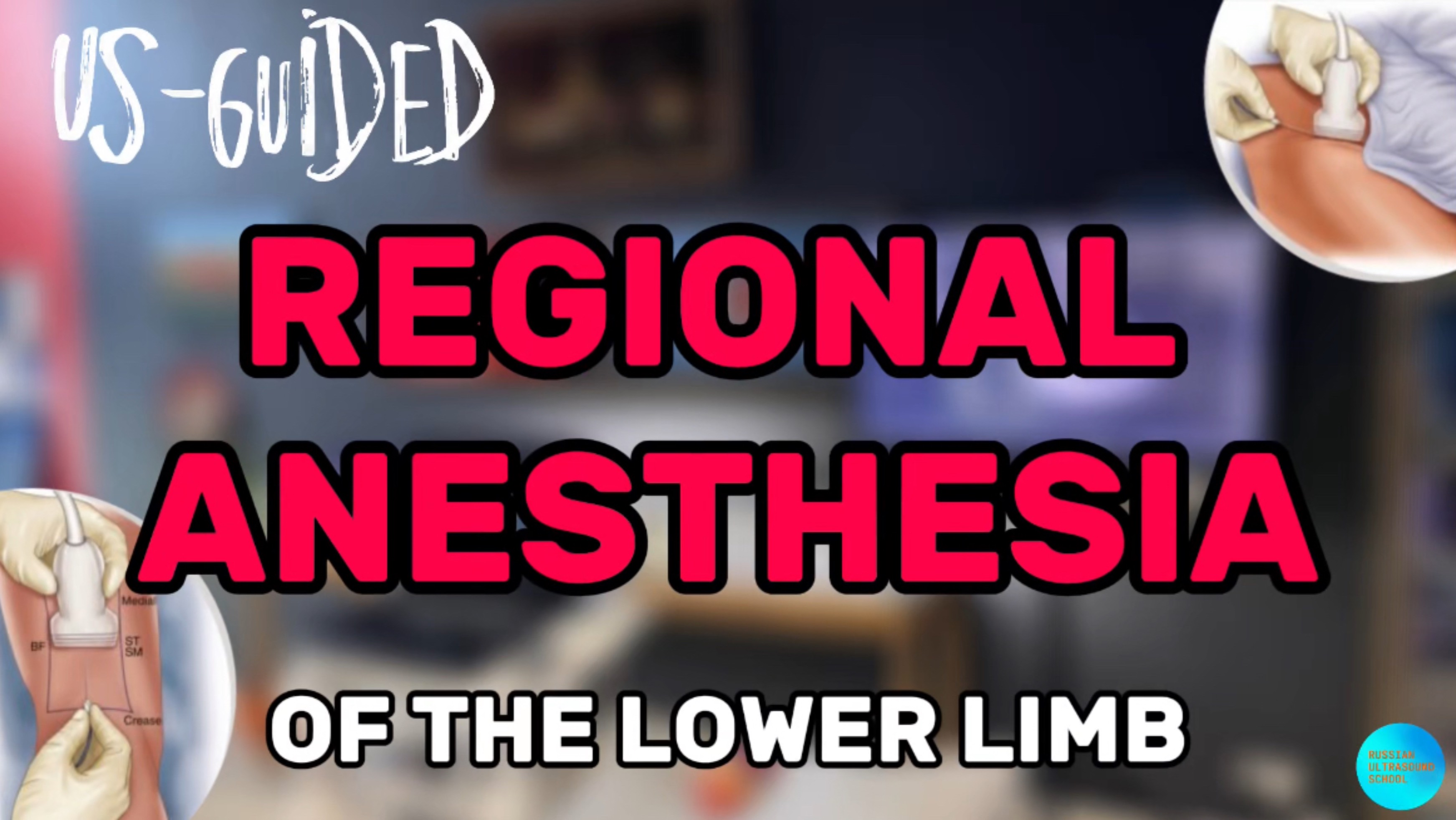 РЕГИОНАРНАЯ АНЕСТЕЗИЯ НИЖНЕЙ КОНЕЧНОСТИ ПОД КОНТРОЛЕМ УЛЬТРАЗВУКА #узи #анестезия #узинавигация