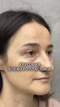 Круговая блефаропластика: ДО и ПОСЛЕ! #блефаропластика #красота #пластика