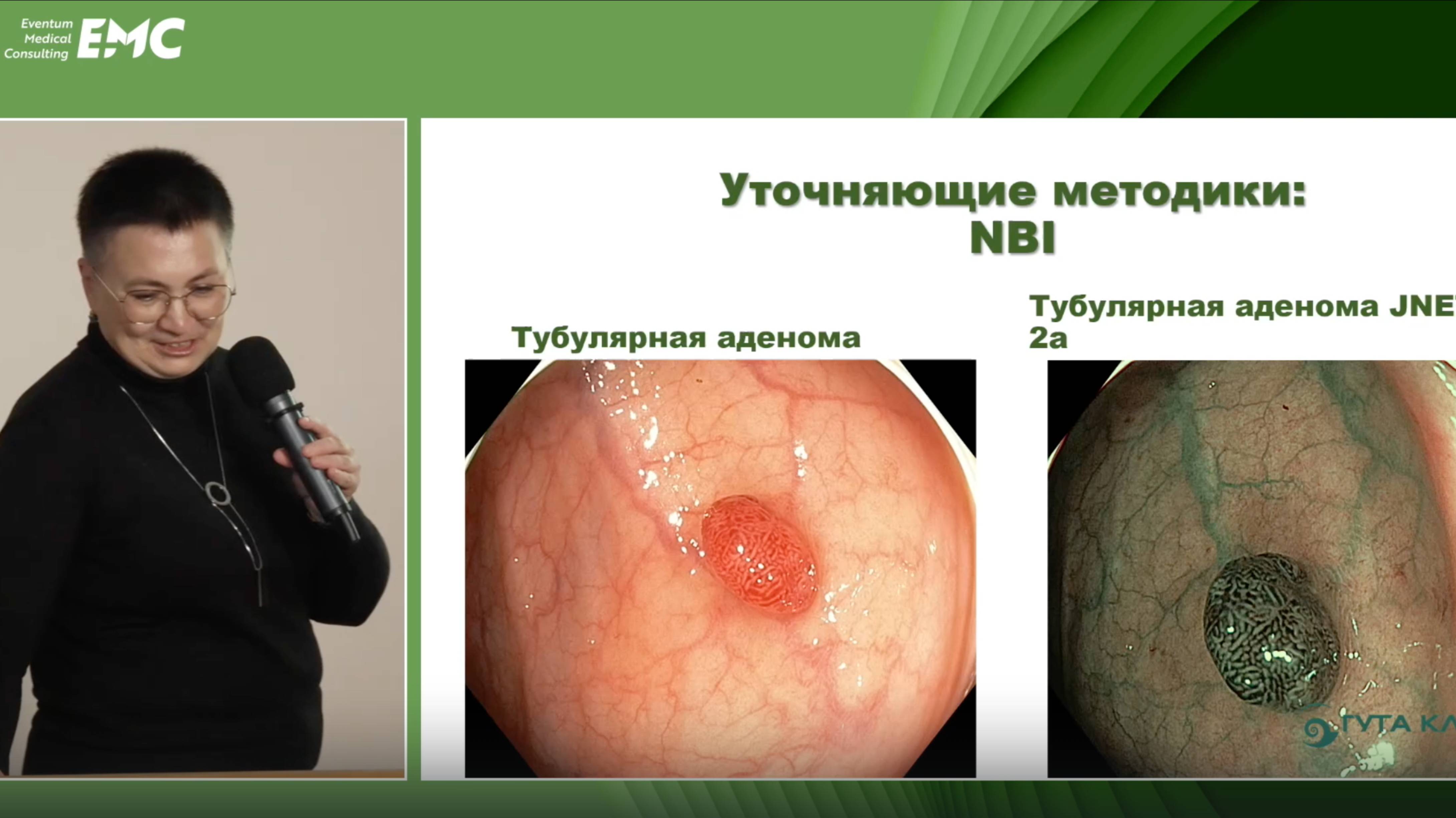 1Хайдурова ТК Анализ собственного опыта скрининг колоноскопий в соответствии с критериями качества