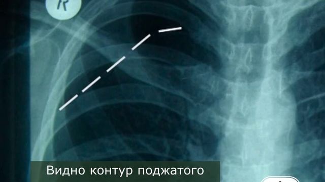 Пневмоторакс_Торакоскопия_с_резекцией_булл