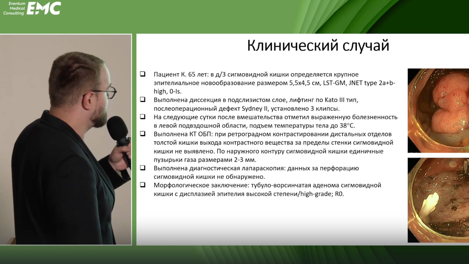 5Погосов НС Ликутов АА Посткоагуляционный синдром: патогенез диффдиагностика, лечение, профилактика