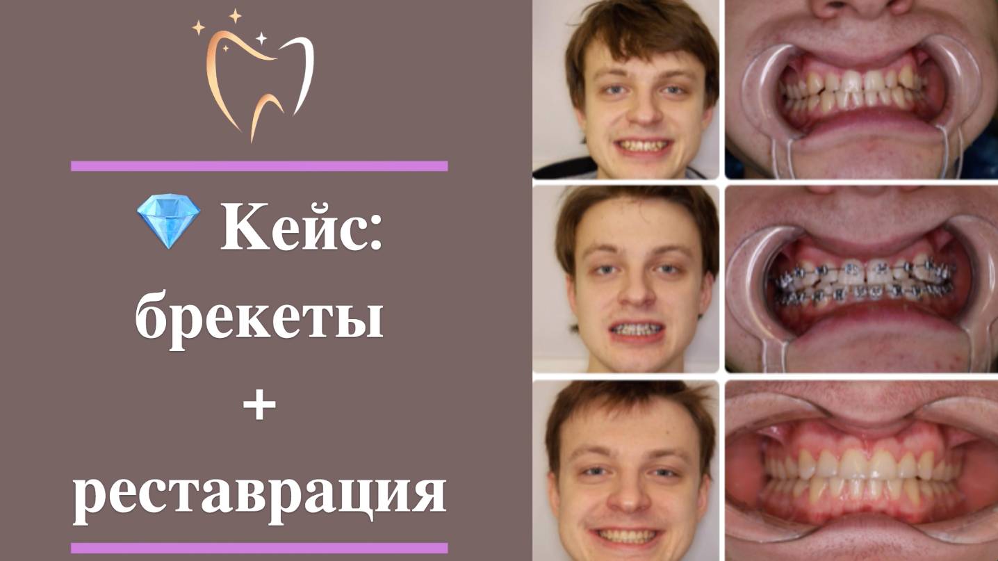 💎 Кейс: брекеты + реставрация