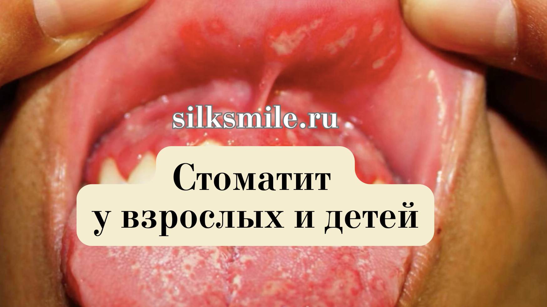 18+ 🚨 Стоматит у взрослых и детей: откуда он берётся и как понять, что уже пора к врачу?